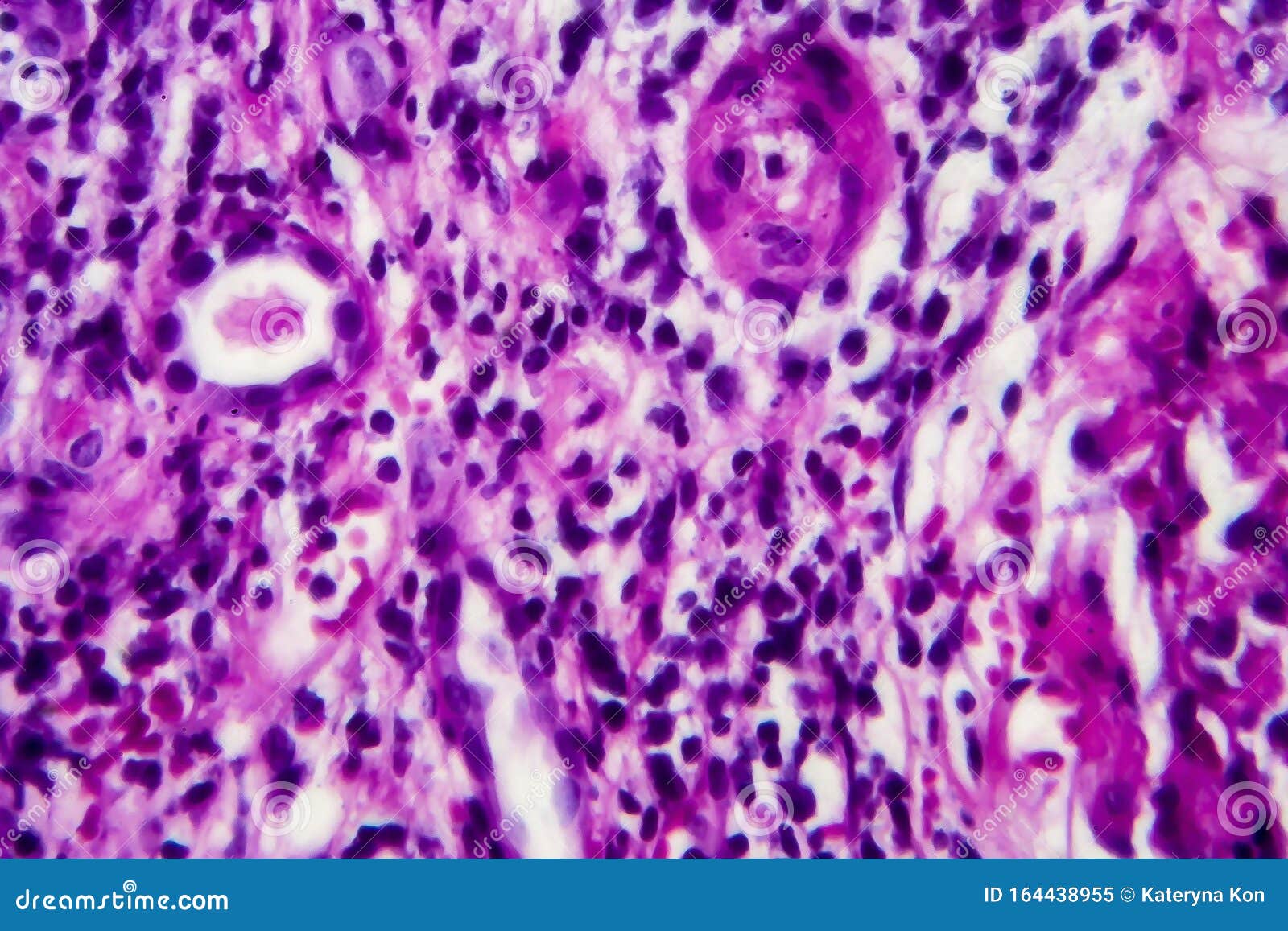 Interstitial Nephritis, Light Micrograph Stock Image - Image of ...