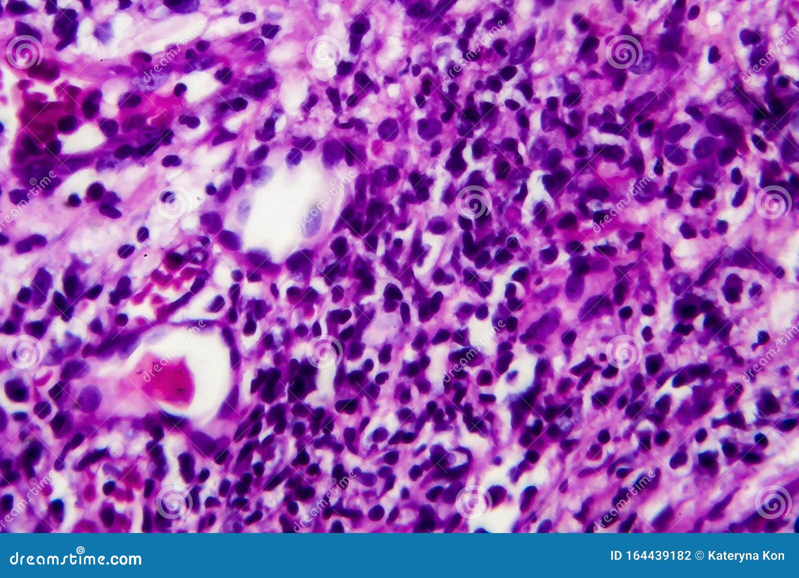 Interstitial Nephritis, Light Micrograph Stock Photo - Image of ...