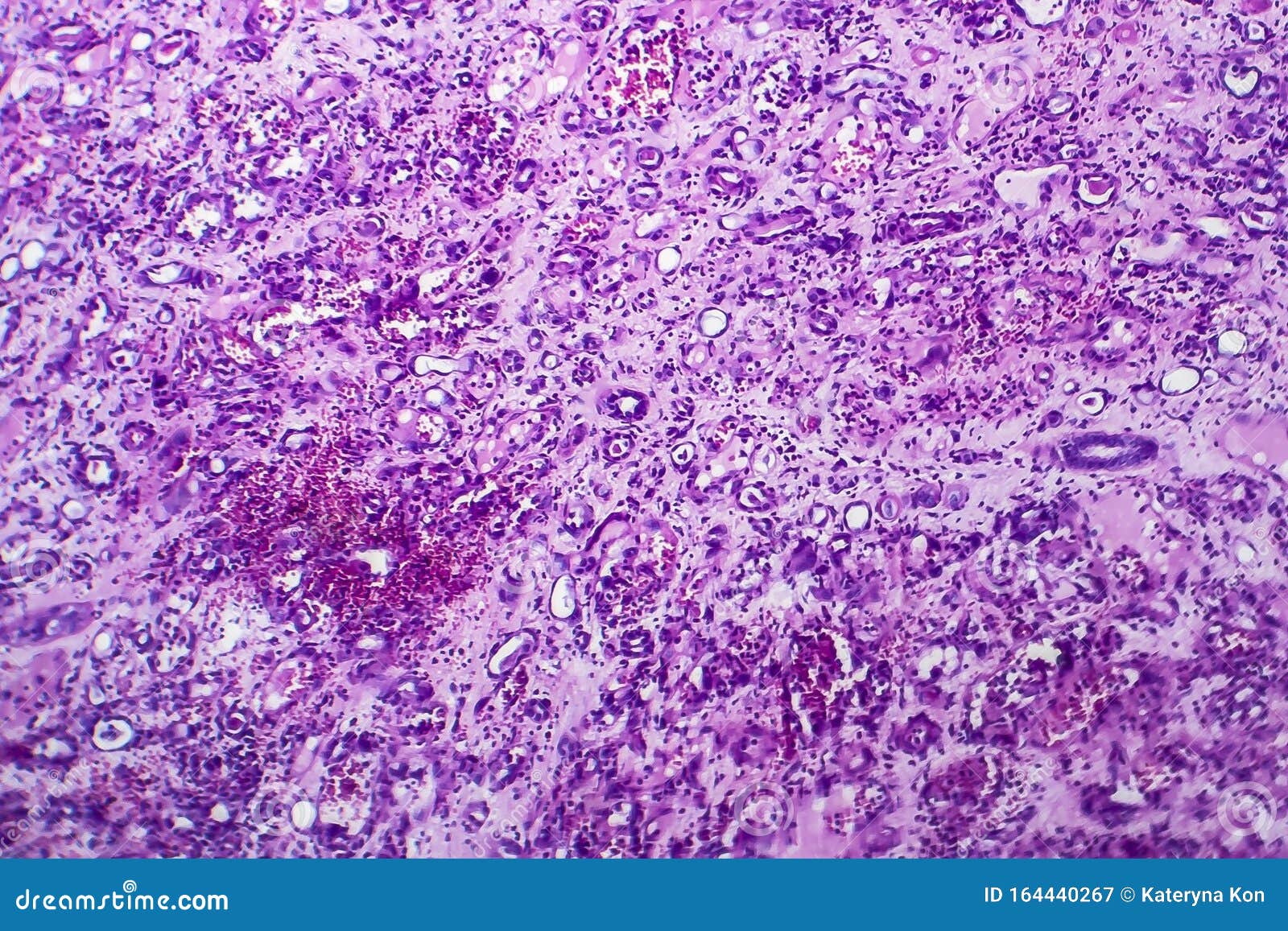 Interstitial Nephritis, Light Micrograph Stock Image - Image of ...