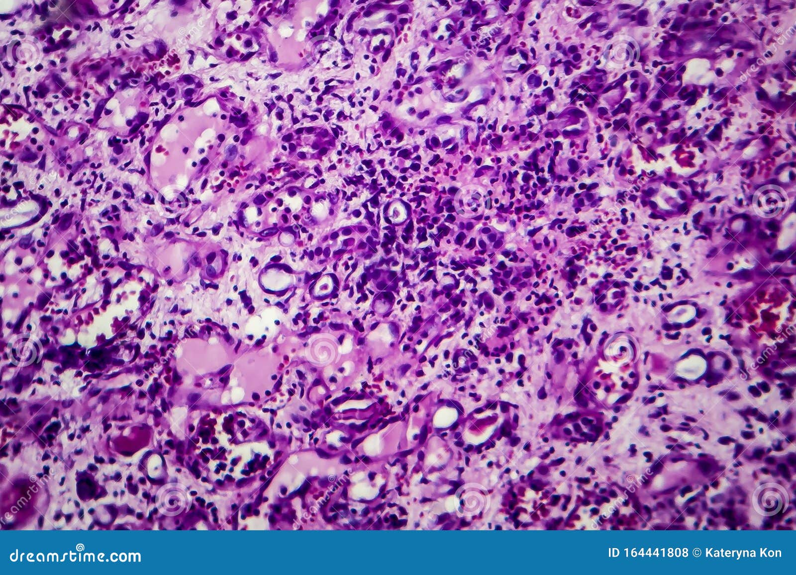 Interstitial Nephritis, Light Micrograph Stock Photo - Image of ...