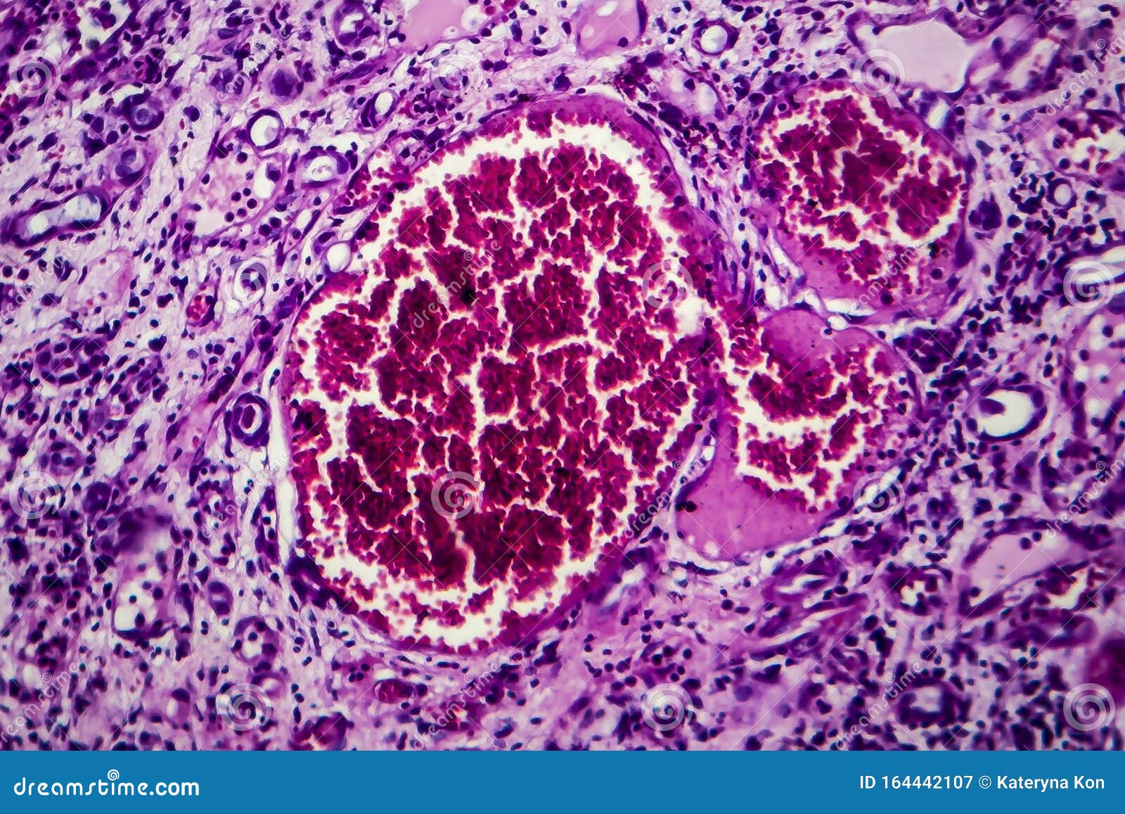 Interstitial Nephritis, Light Micrograph Stock Image - Image of urinary ...