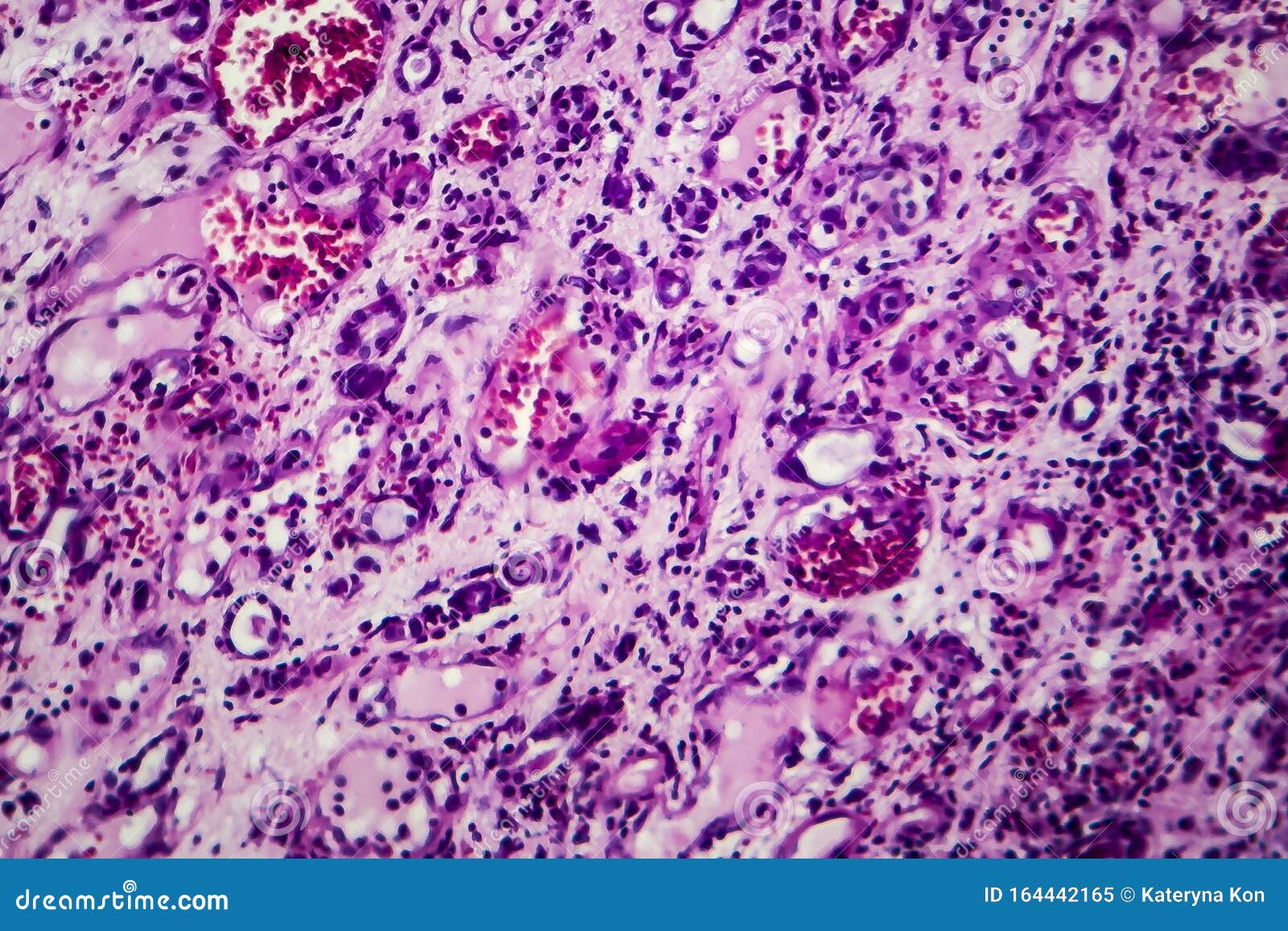 Interstitial Nephritis, Light Micrograph Stock Image - Image of ...