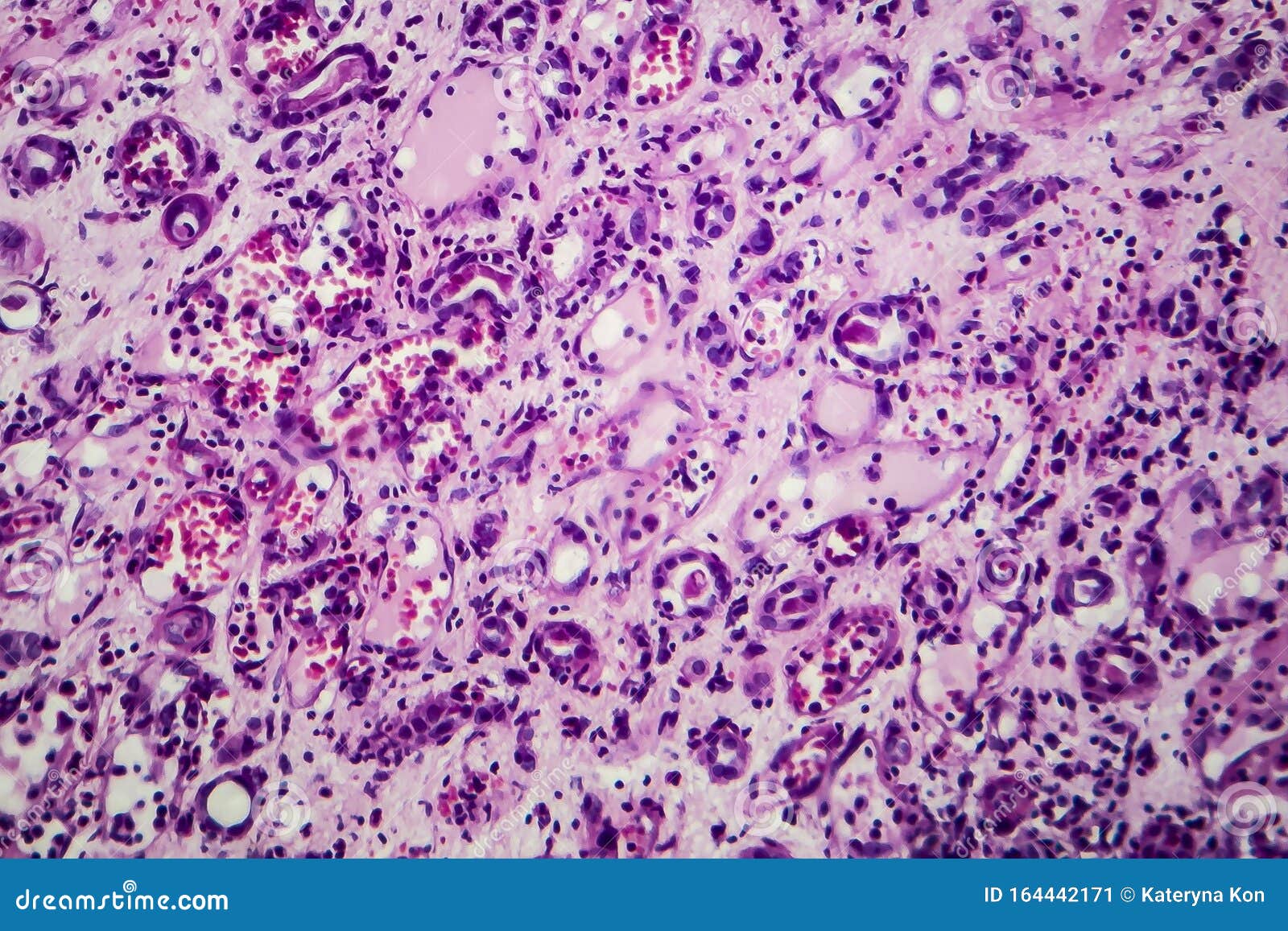 Interstitial Nephritis, Light Micrograph Stock Image - Image of stain ...