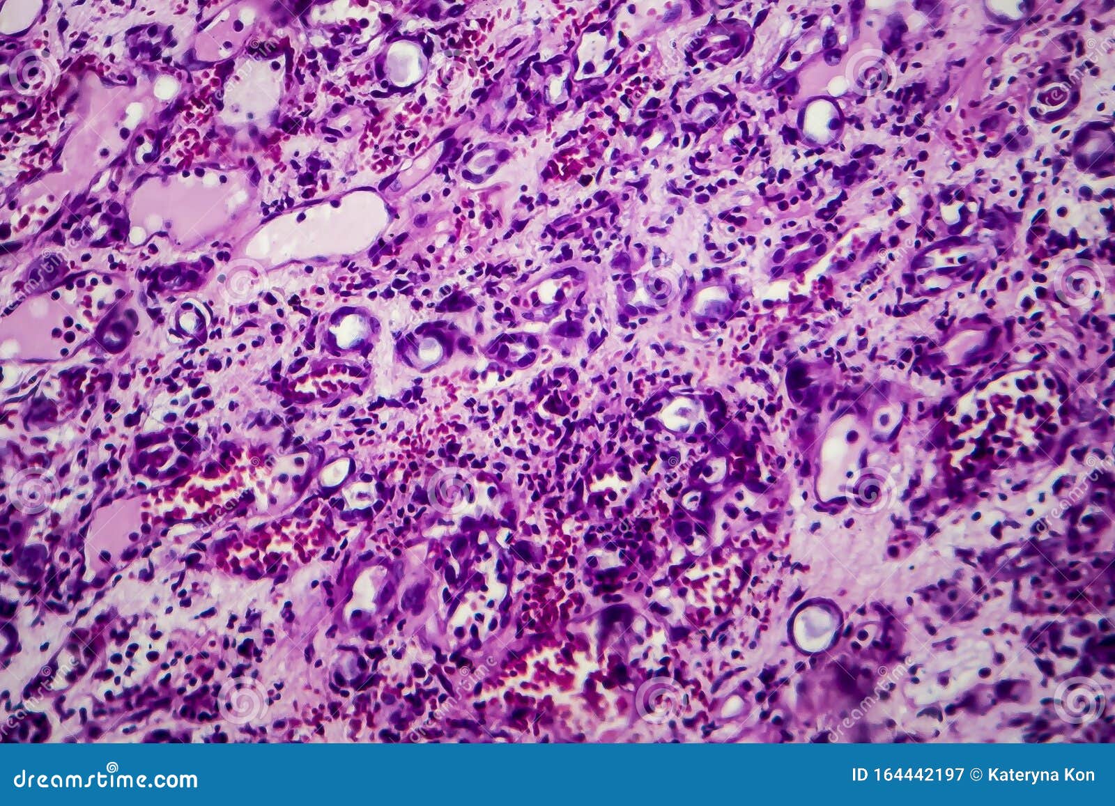 Interstitial Nephritis, Light Micrograph Stock Image - Image of ...