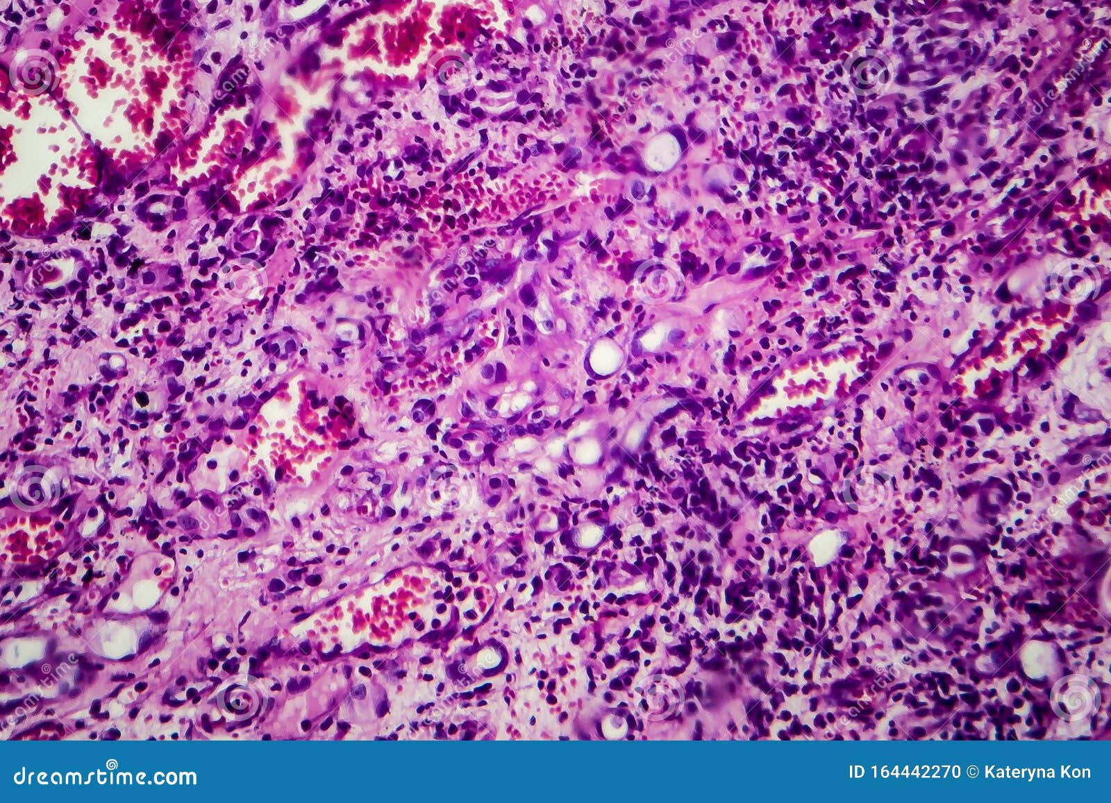 Interstitial Nephritis, Light Micrograph Stock Photo - Image of ...