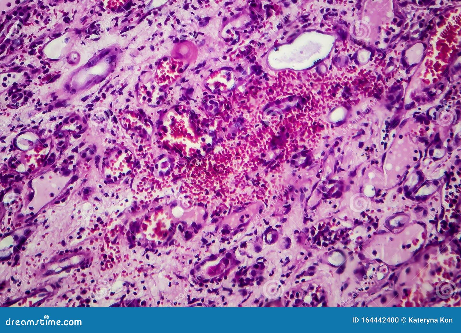 Interstitial Nephritis, Light Micrograph Stock Photo - Image of ...