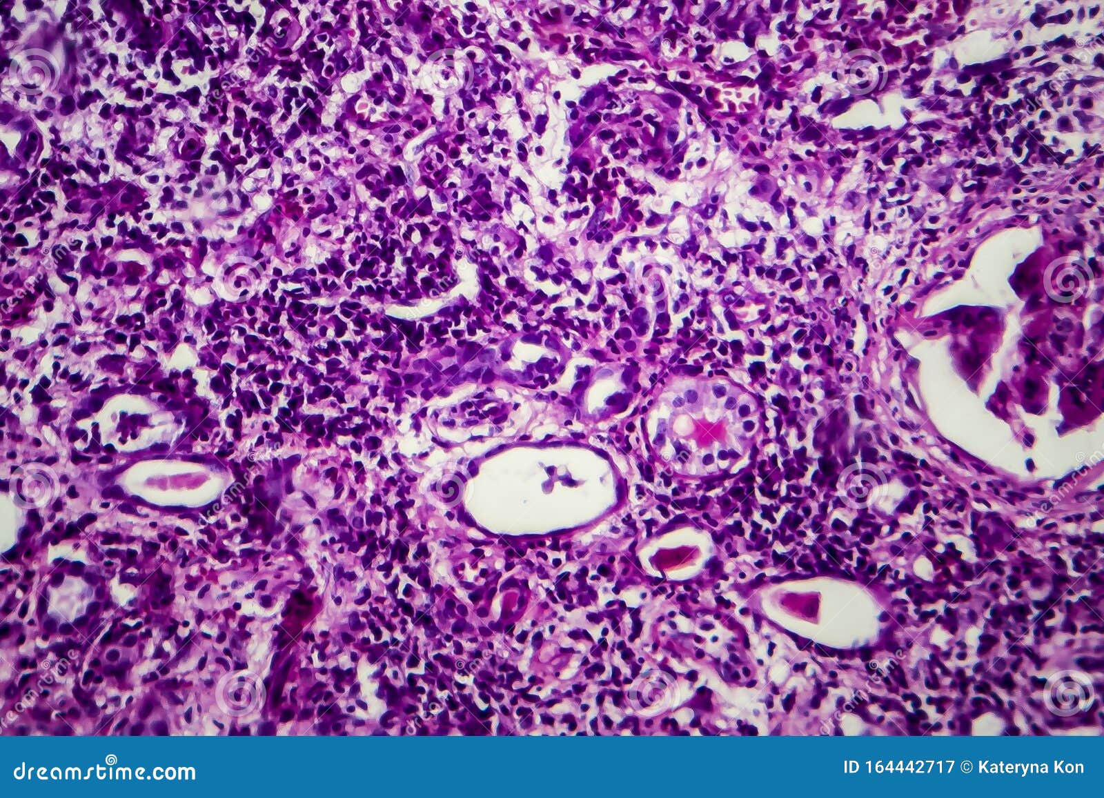 Interstitial Nephritis, Light Micrograph Stock Image - Image of ...