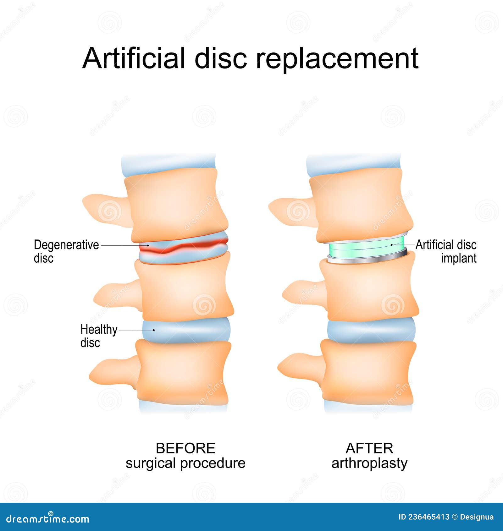 Intervertebral Disc Arthroplasty Stock Illustration - Illustration of ...