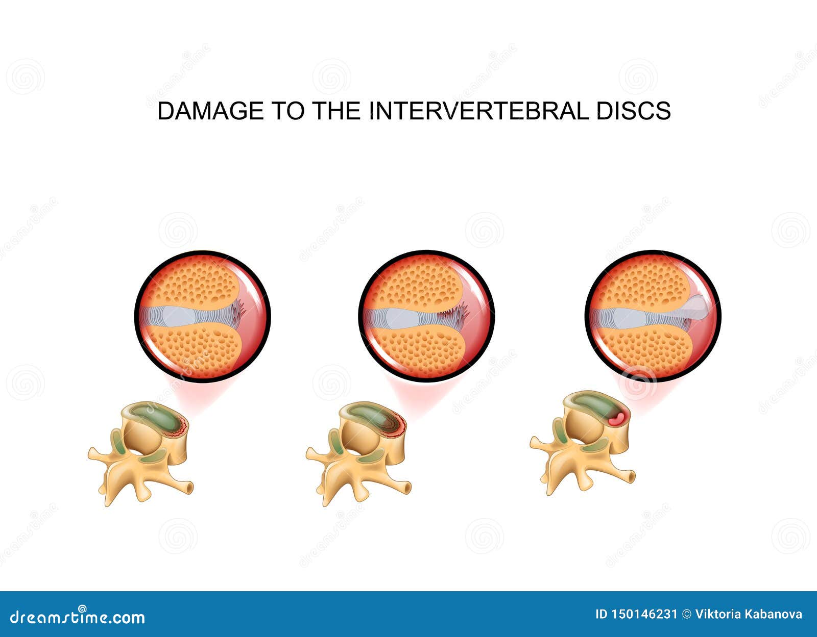 Intervertebral Disc Damage. Vertebra Cartoon Vector | CartoonDealer.com ...