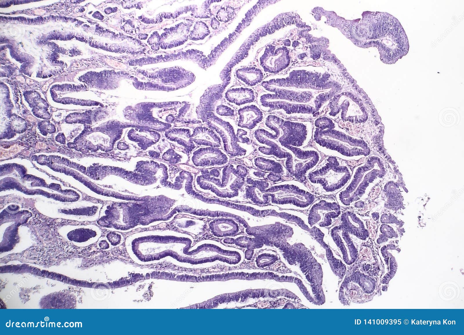 Intestinal Adenomas, Light Micrograph Stock Image - Image of ...