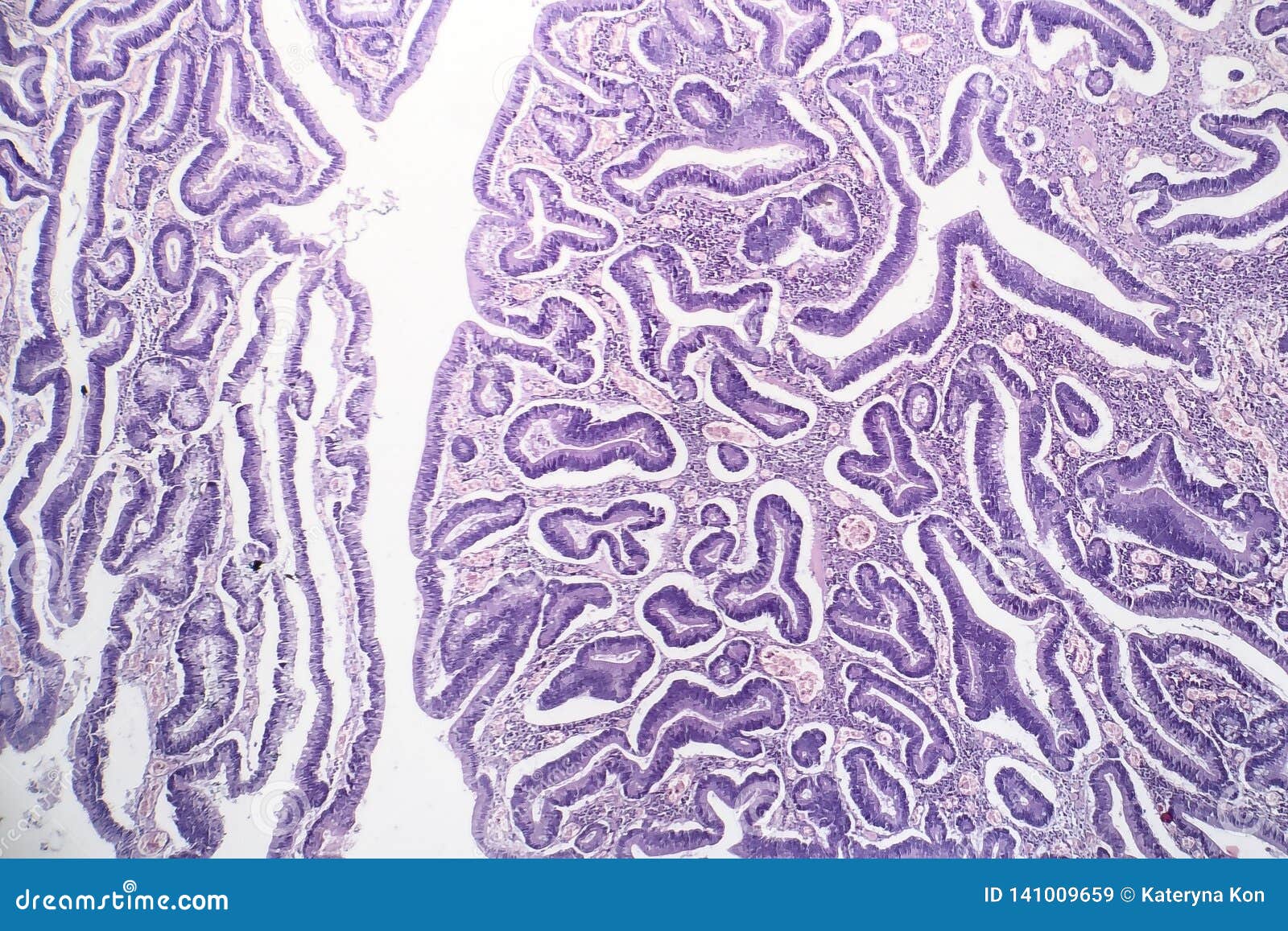 Intestinal Adenomas, Light Micrograph Stock Image - Image of tissue ...