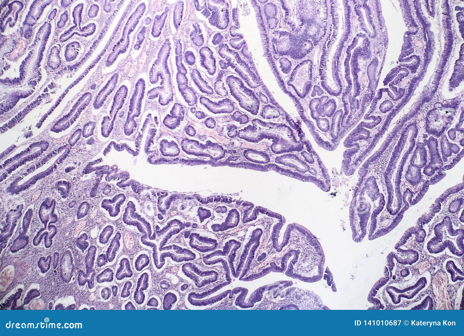 Intestinal Adenomas, Light Micrograph Stock Image - Image of bowel ...