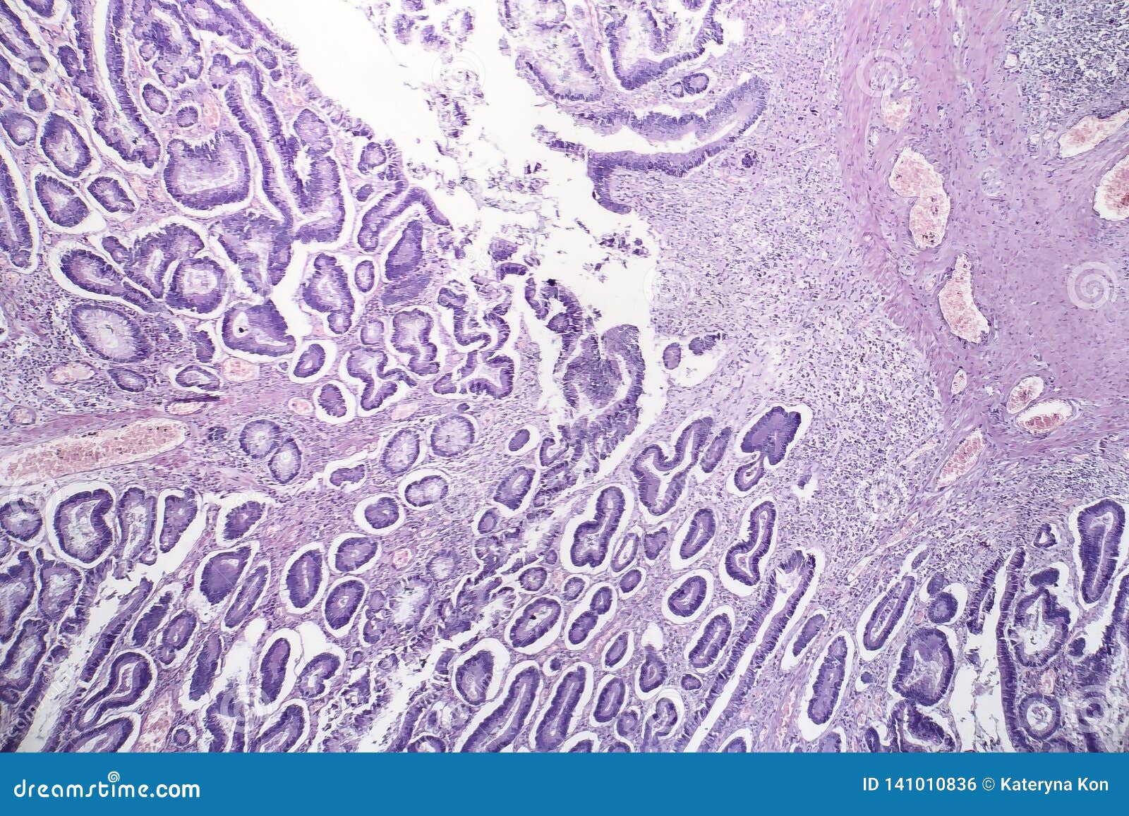 Intestinal Adenomas, Light Micrograph Stock Photo - Image of ...