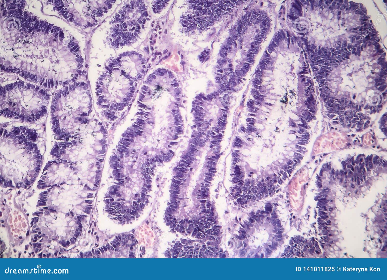 Intestinal Adenomas, Light Micrograph Royalty-Free Stock Image ...