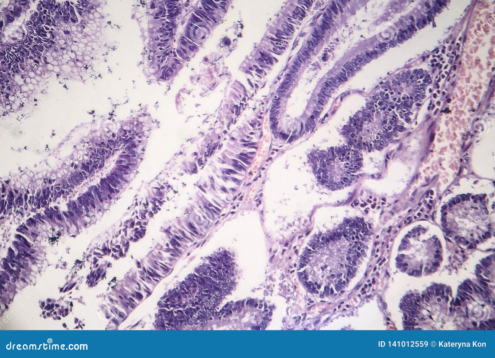 Intestinal Adenomas, Light Micrograph Stock Image - Image of microscopy ...