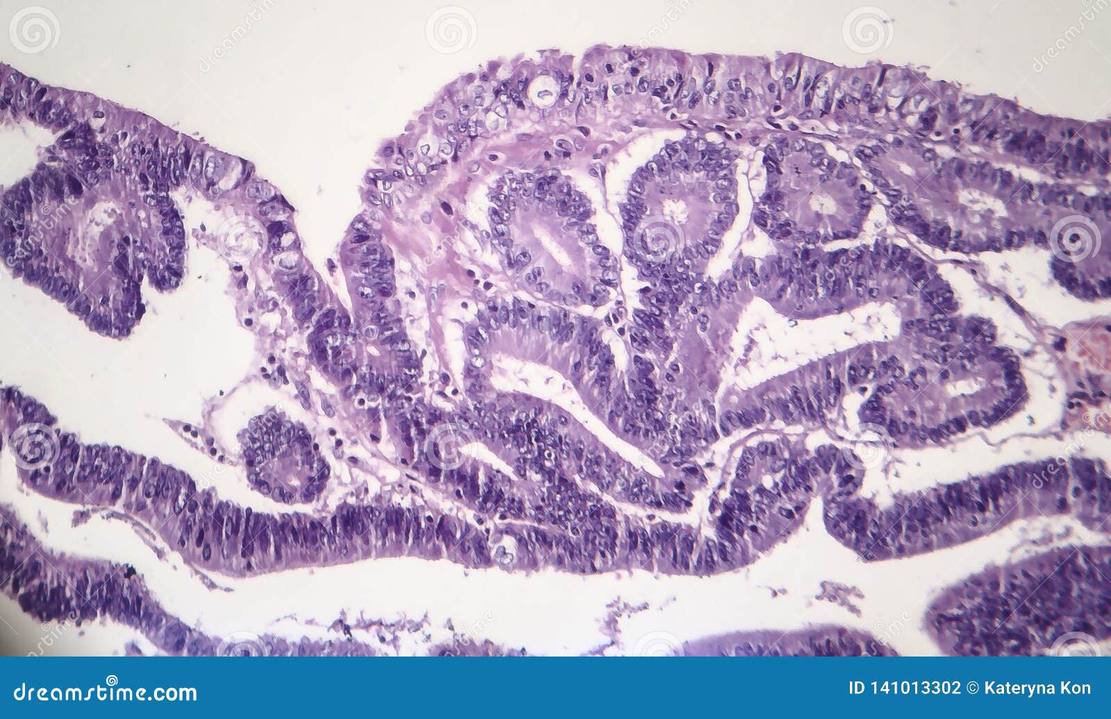 Intestinal Adenomas, Light Micrograph Stock Photo - Image of micro ...