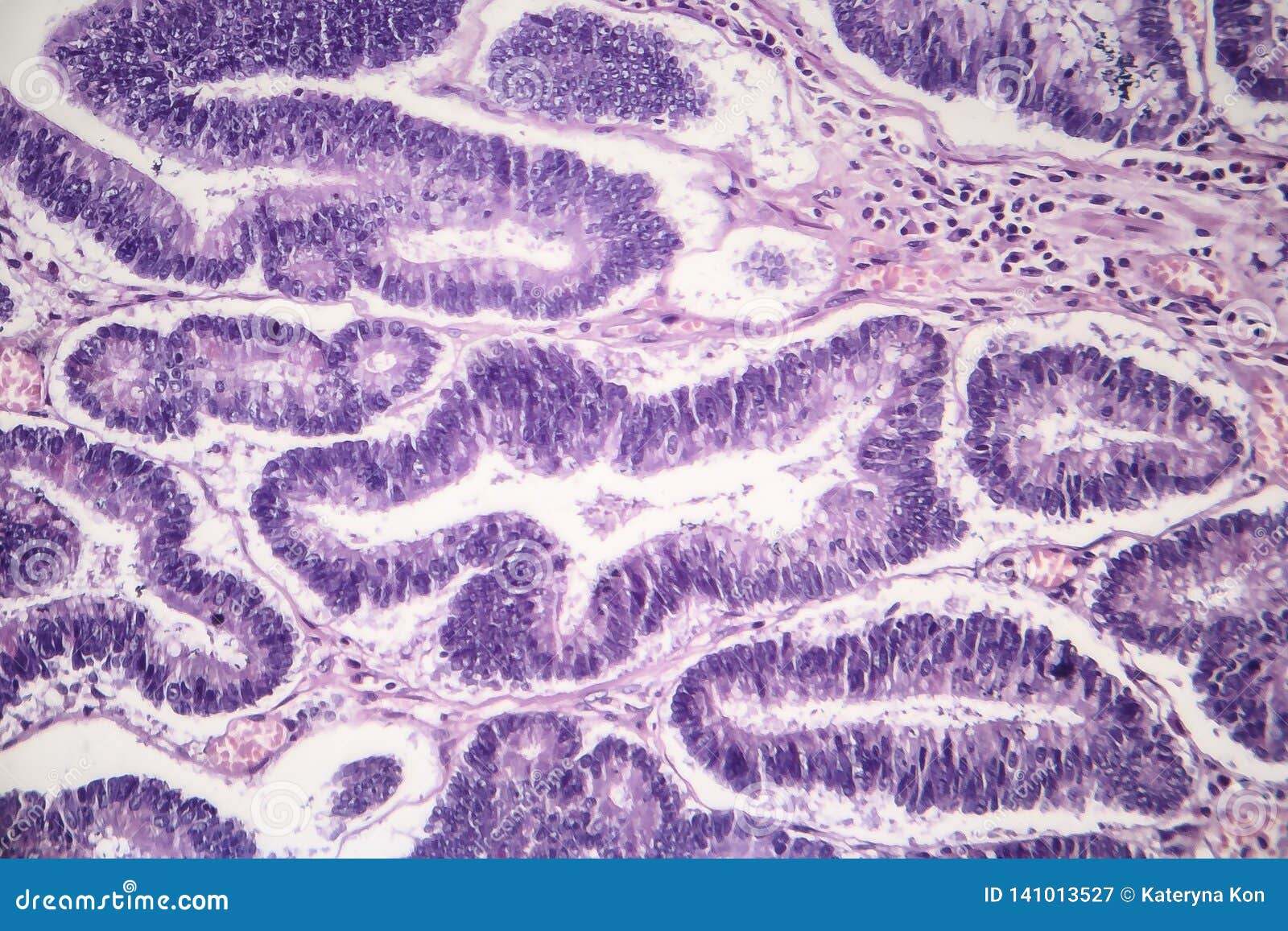 Intestinal Adenomas, Light Micrograph Stock Image - Image of tissue ...