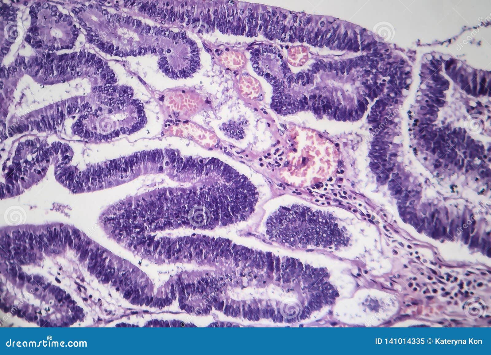 Intestinal Adenomas, Light Micrograph Stock Image - Image of micro ...