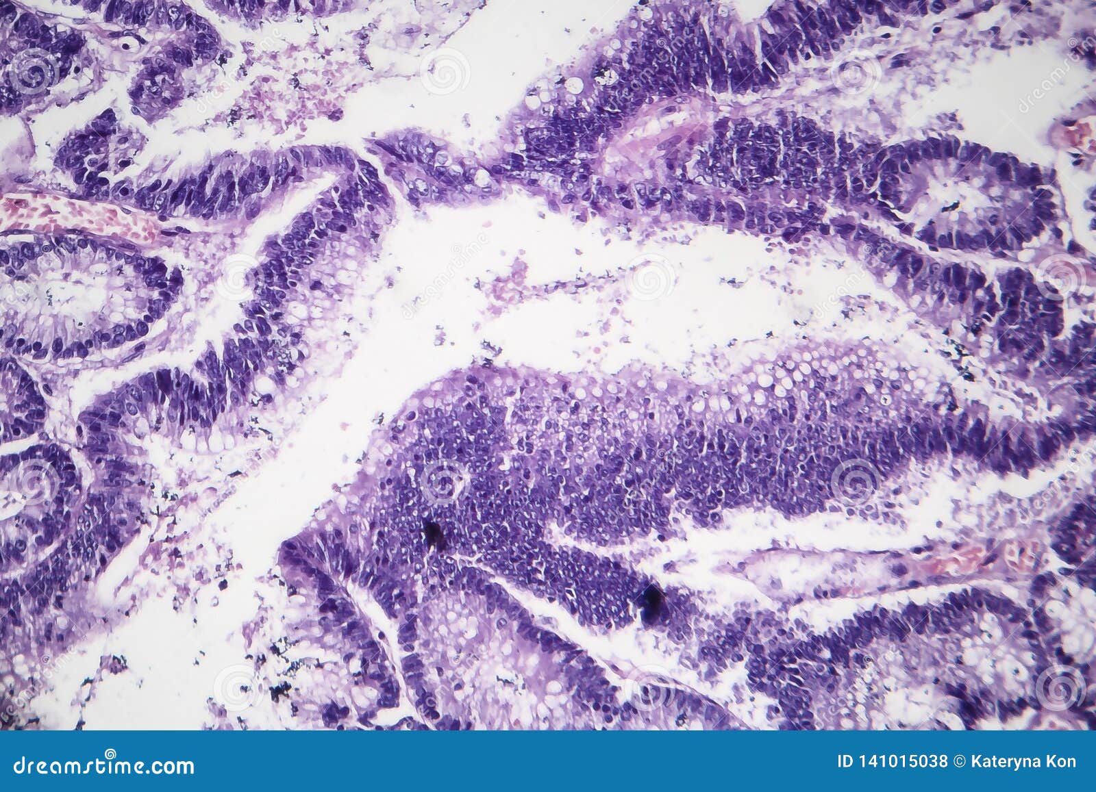 Intestinal Adenomas, Light Micrograph Stock Photo - Image of ...