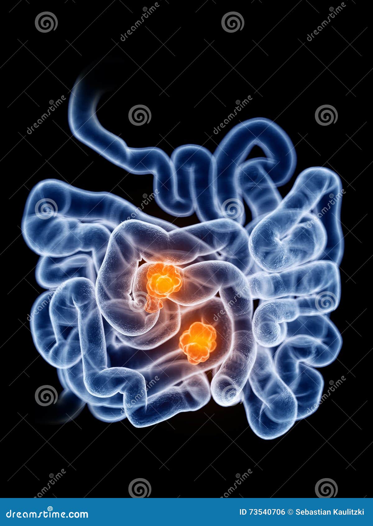 Intestinal Cancer Royalty-Free Cartoon | CartoonDealer.com #73540706