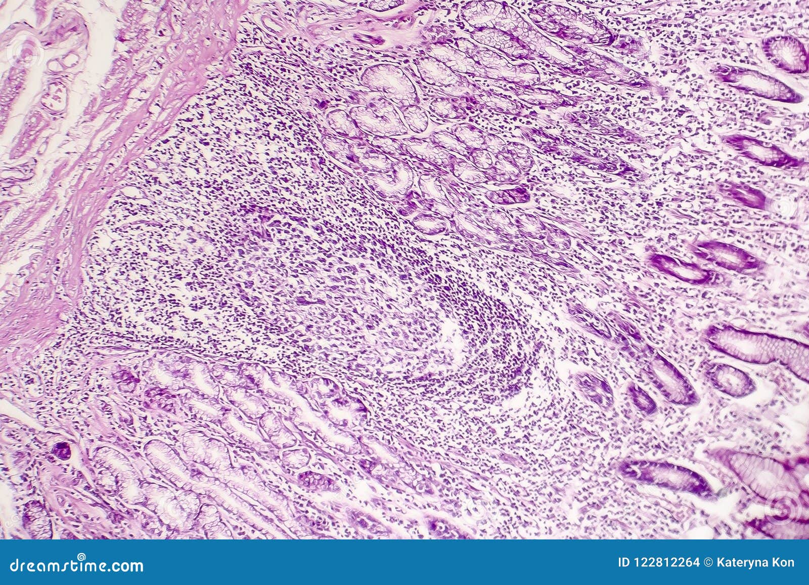 Intestinal Metaplasia, Light Micrograph Stock Photo - Image of ...