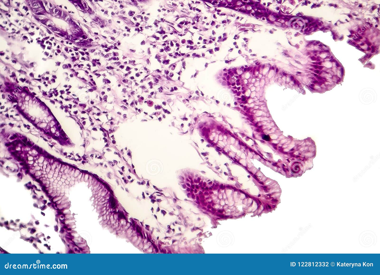 Intestinal Metaplasia Of Gastric Mucosa Stock Image | CartoonDealer.com ...