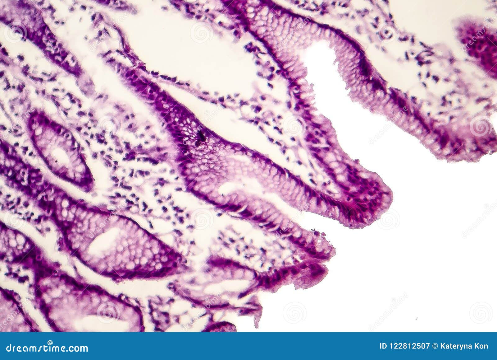 Intestinal Metaplasia, Light Micrograph Stock Image - Image of ...
