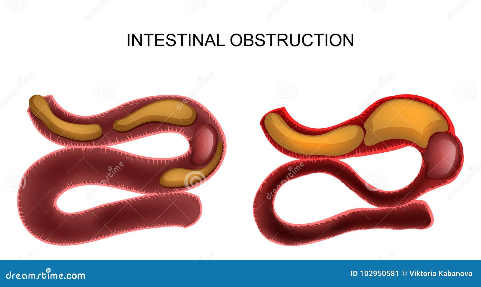 Ileus Stock Illustrations – 10 Ileus Stock Illustrations, Vectors ...