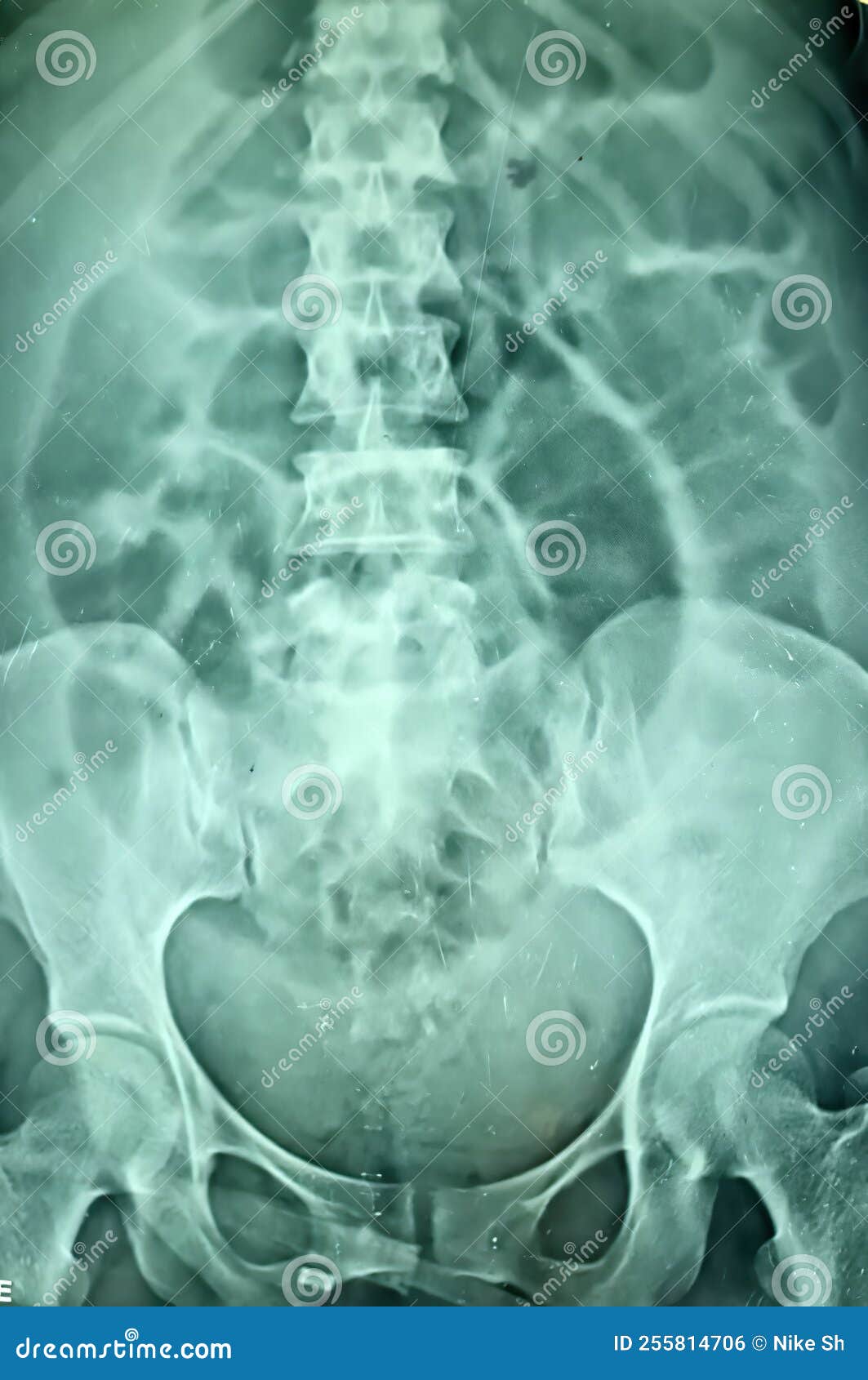 Intestinal obstruction stock photo. Image of xray, intestinal - 255814706 Intestinal obstruction stock photo. Image of xray, intestinal - 255814706