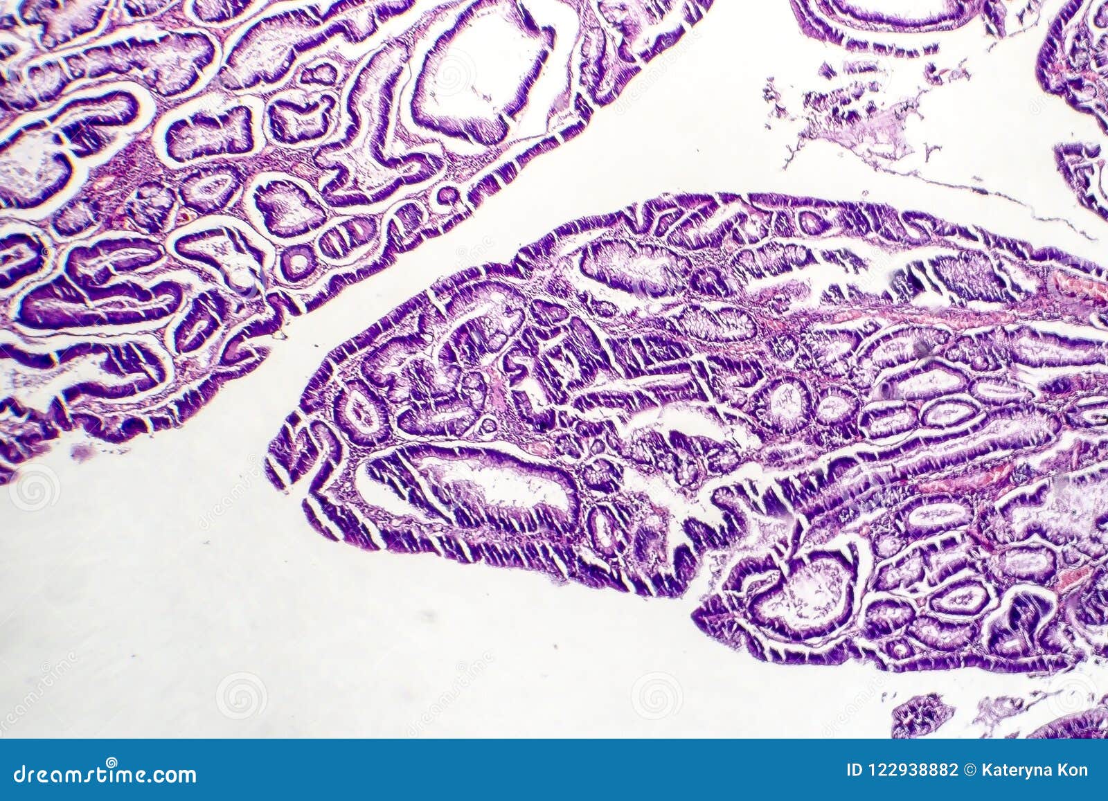Intestinal Polypoid Adenoma Stock Photo - Image of micrograph ...