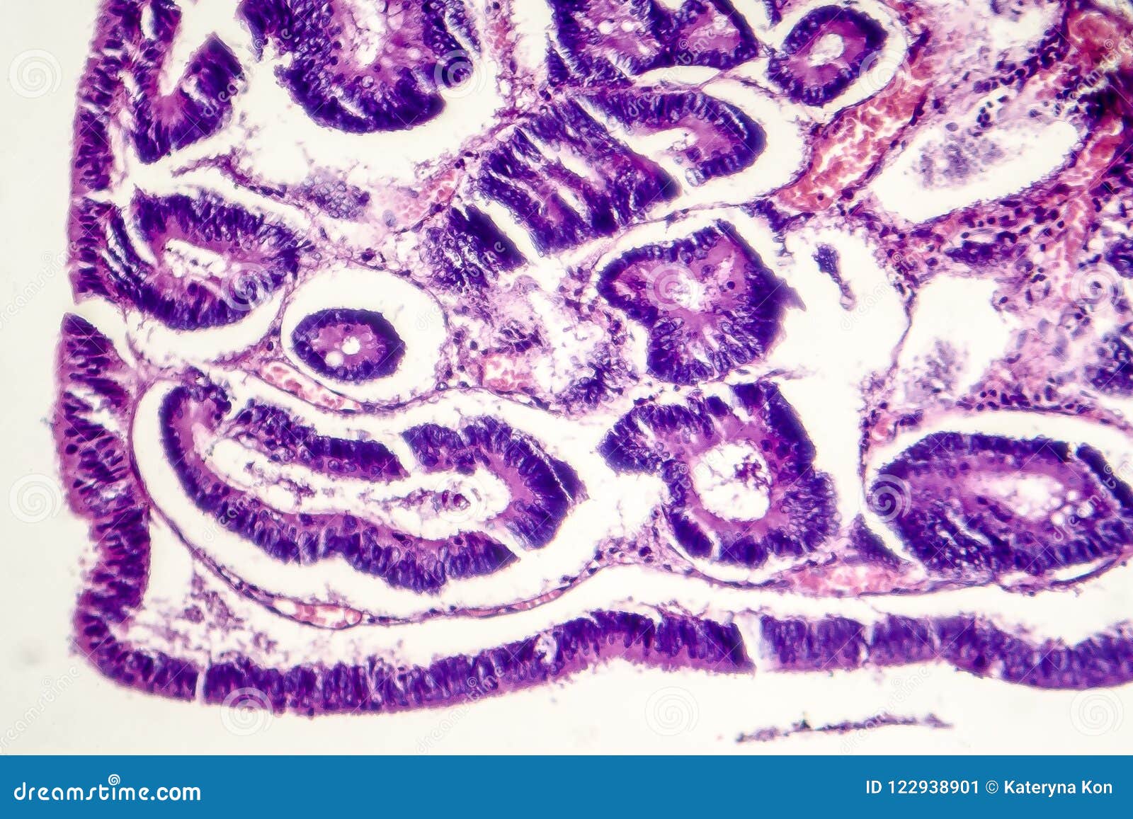 Intestinal Polypoid Adenoma Stock Image - Image of pathohistology ...