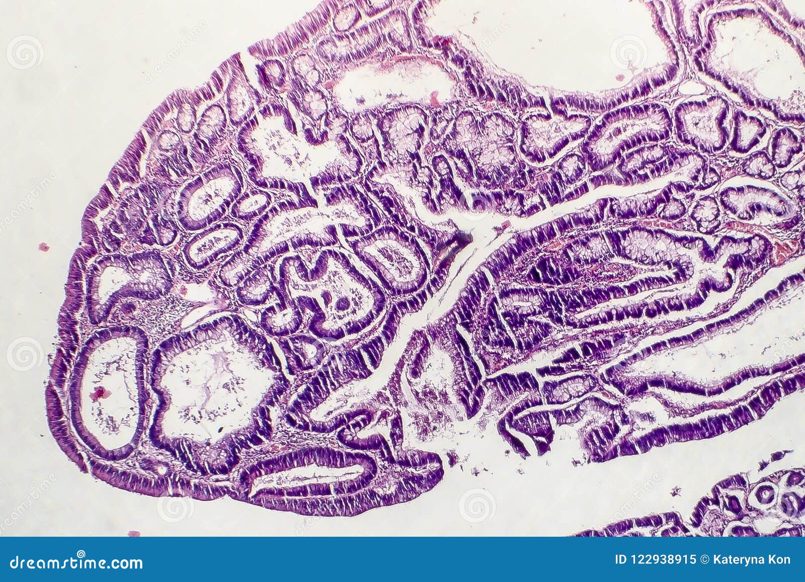 Intestinal Polypoid Adenoma Stock Image - Image of microscope, micro ...