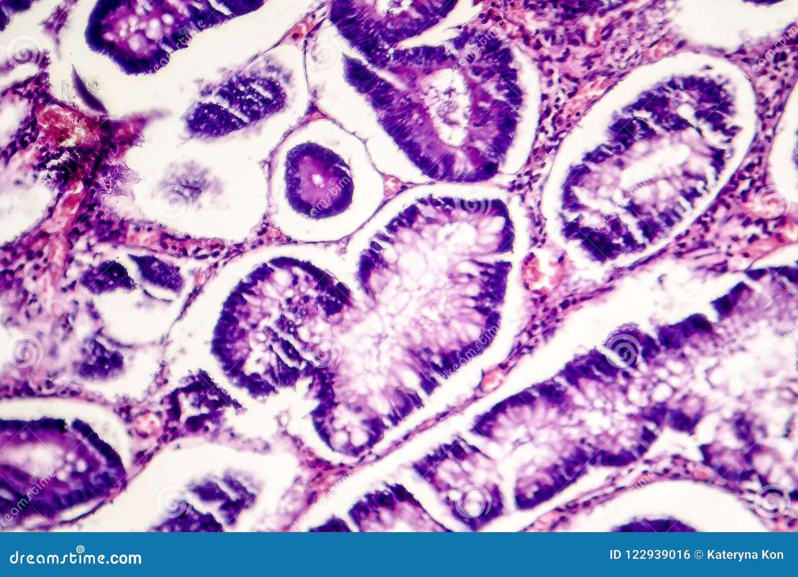 Intestinal Polypoid Adenoma Stock Photo - Image of morphological, stain ...