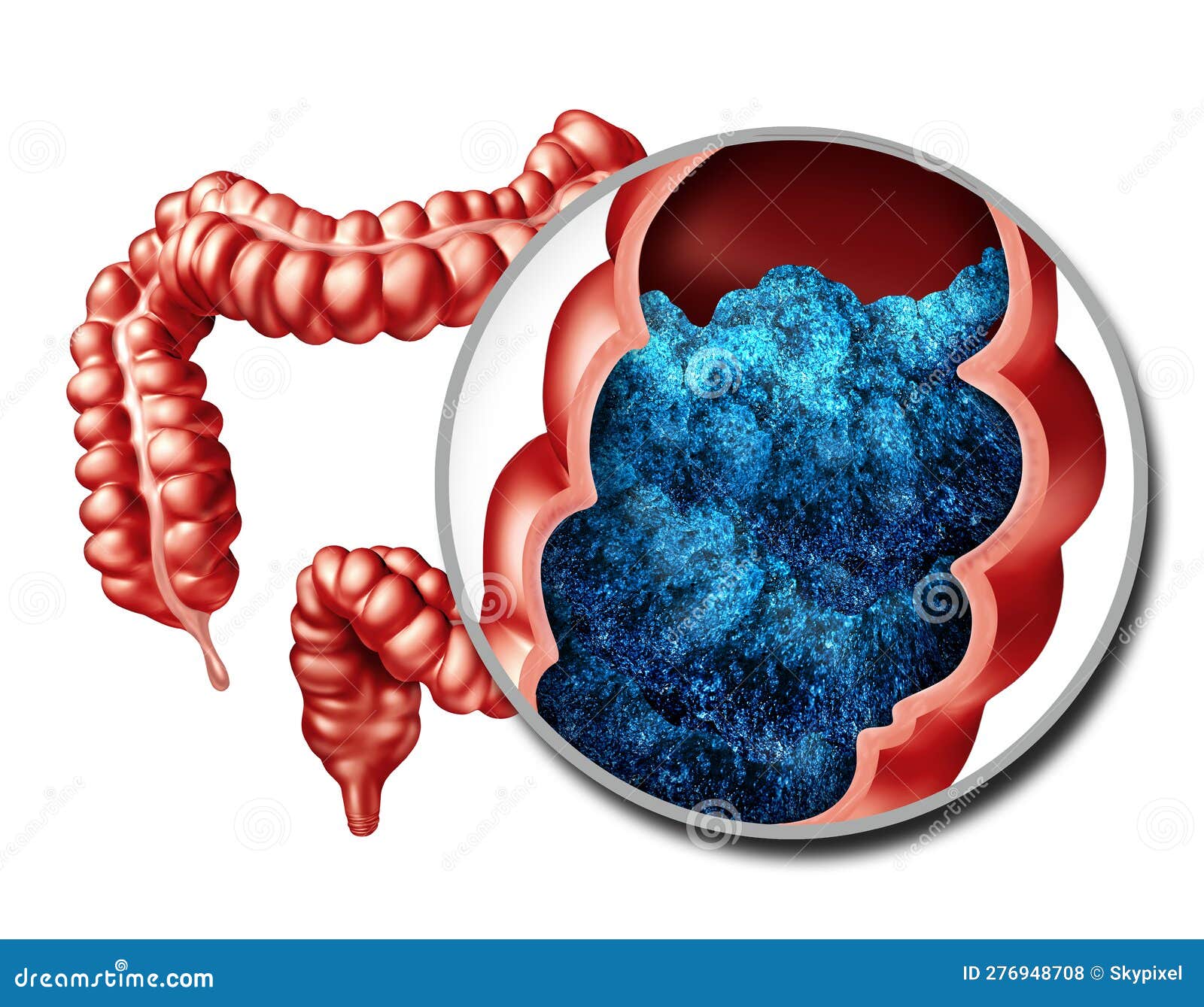Intestine With Constipation Internal Organs Digestive System. Abdominal ... Intestine With Constipation Internal Organs Digestive System. Abdominal ...
