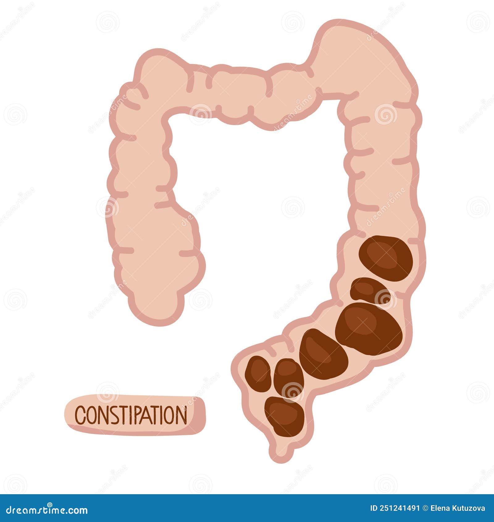 Intestine With Constipation Internal Organs Digestive System. Abdominal ... Intestine With Constipation Internal Organs Digestive System. Abdominal ...