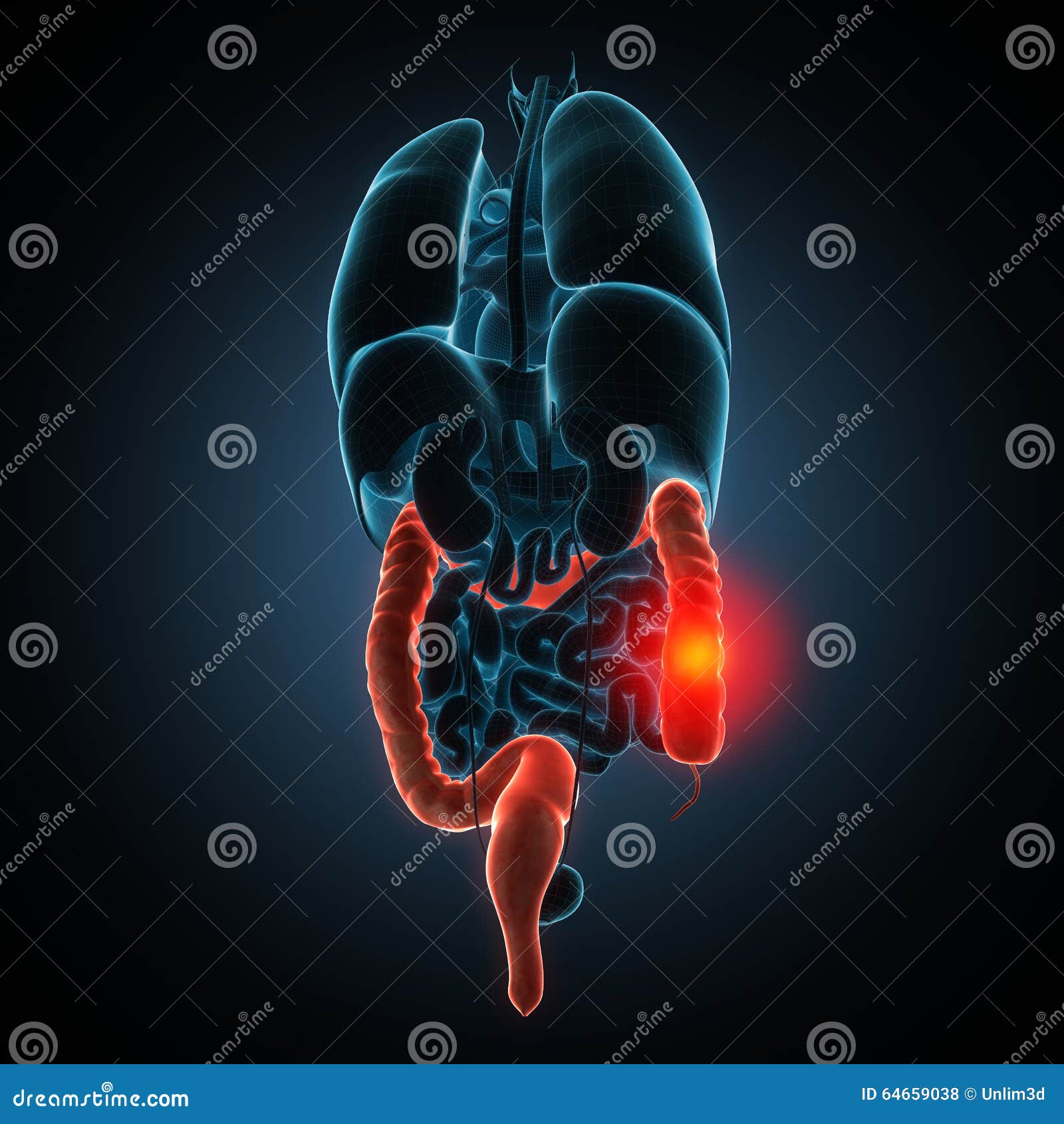 Intestines Disease Illustration Stock Illustration - Illustration of ...