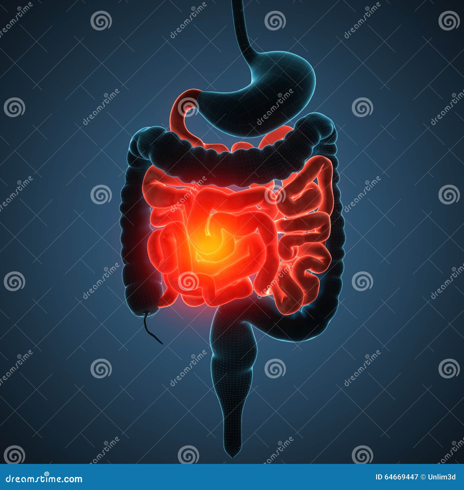Intestines Disease Illustration Stock Illustration - Illustration of ...