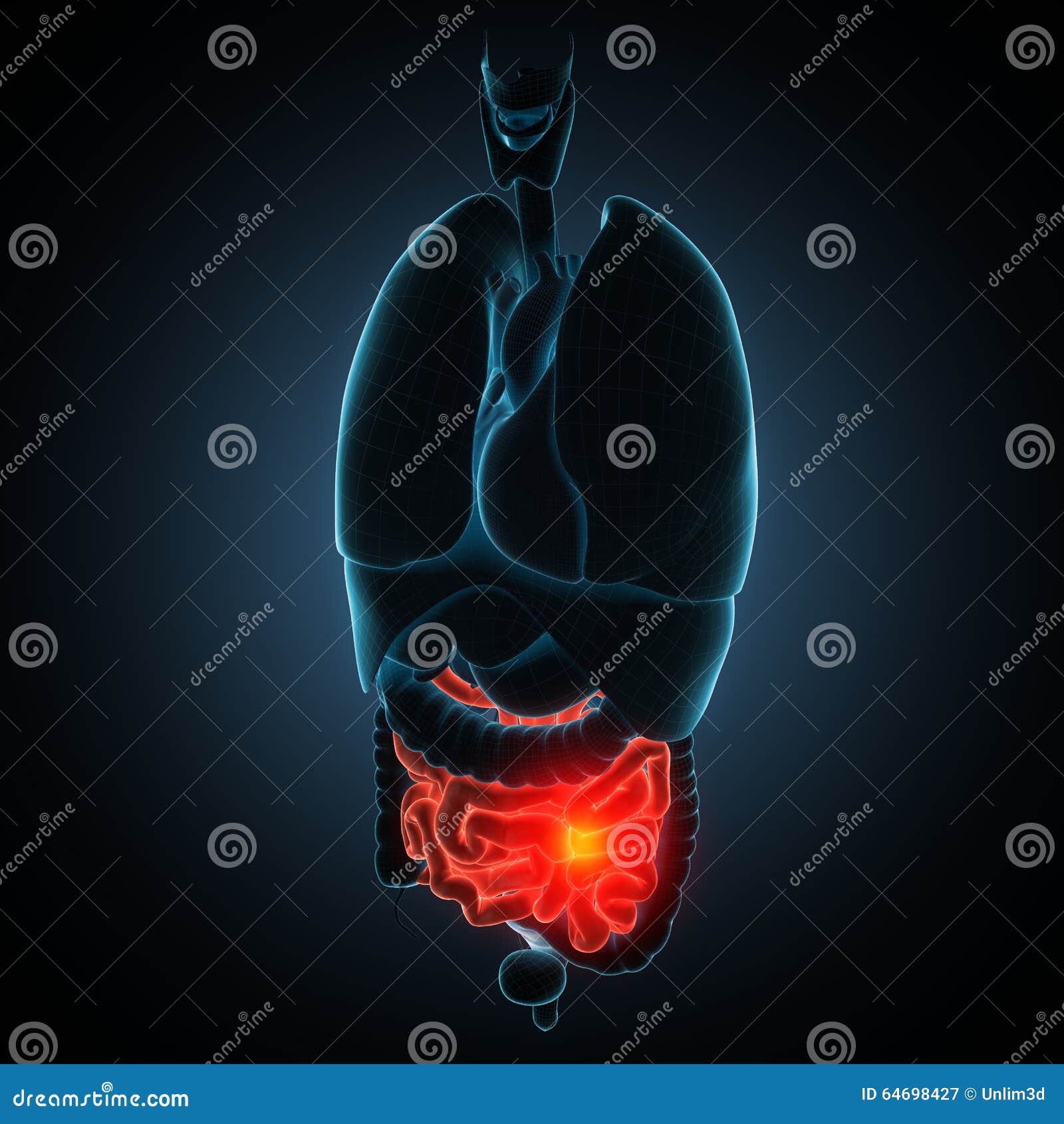 Intestines Disease Illustration Stock Illustration - Illustration of ...