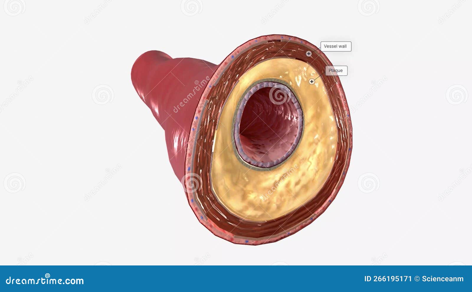 Intra Arterial Plaque Formation and Narrowing Stock Video - Video of ...