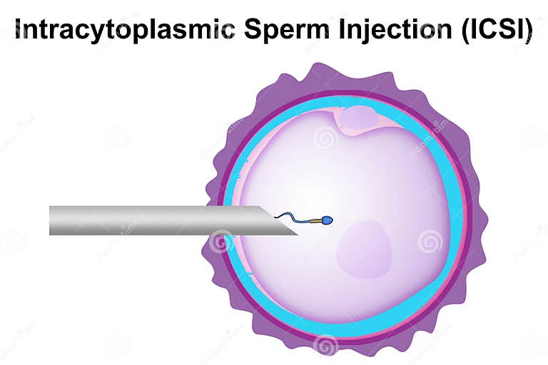 Intracytoplasmic Sperm Injection Icsi Process Diagram Stock