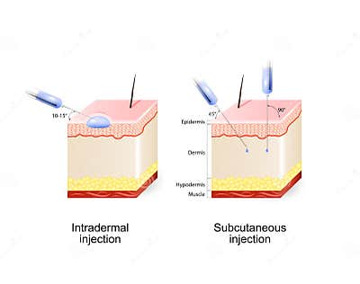 Intradermal and Subcutaneous Injection Stock Vector - Illustration of ...