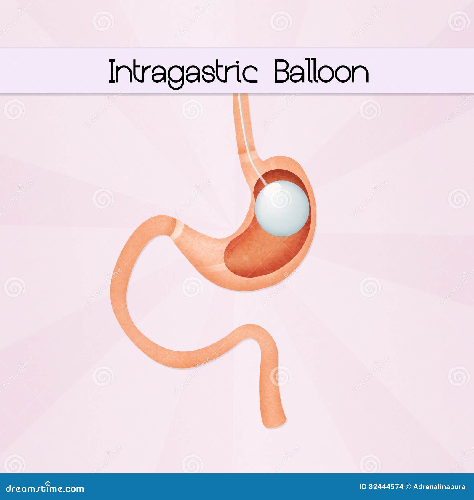 Intragastric Balloon Royalty-Free Stock Photography | CartoonDealer.com ...
