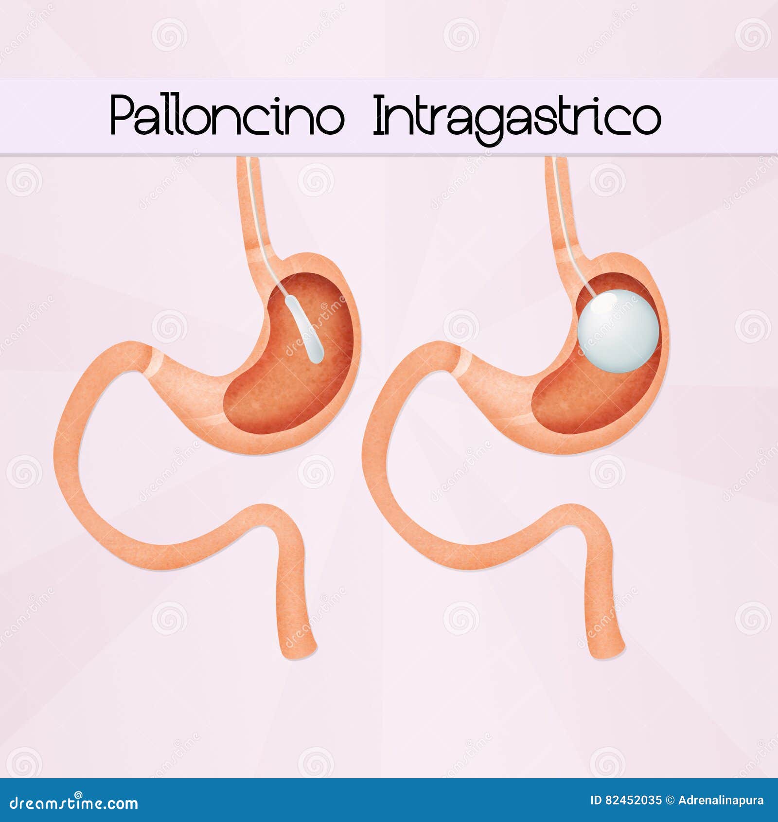 Intragastric balloon stock illustration. Illustration of balloon - 82452035