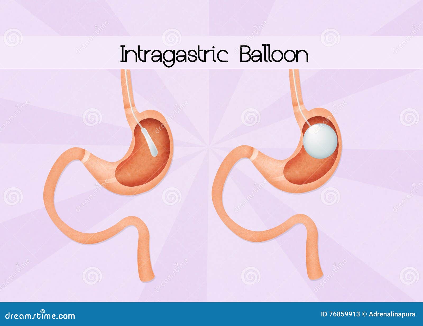 Intragastric balloon stock illustration. Illustration of balloon - 76859913