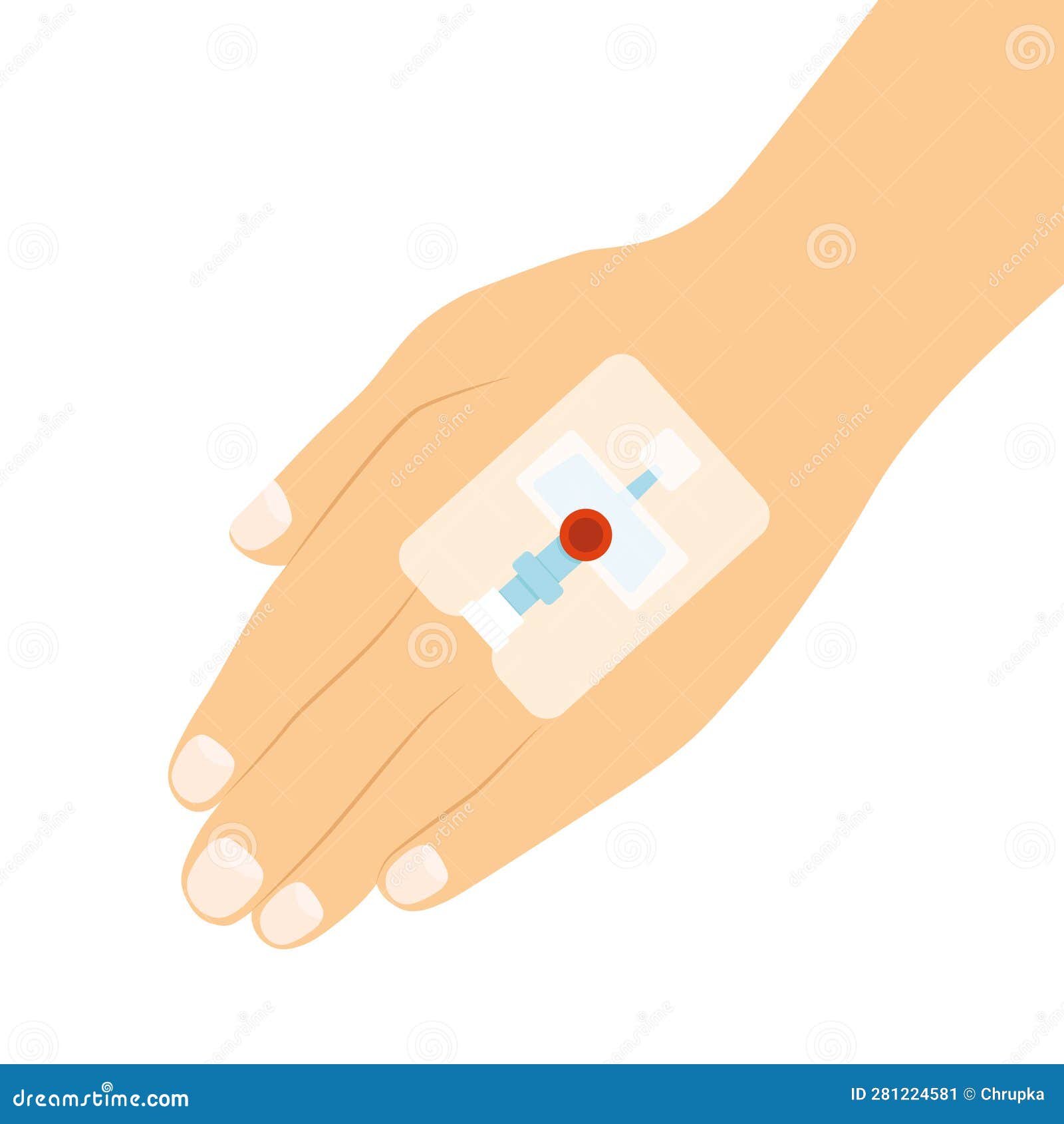Intravenous Cannula on Hand Stock Vector - Illustration of drug ...