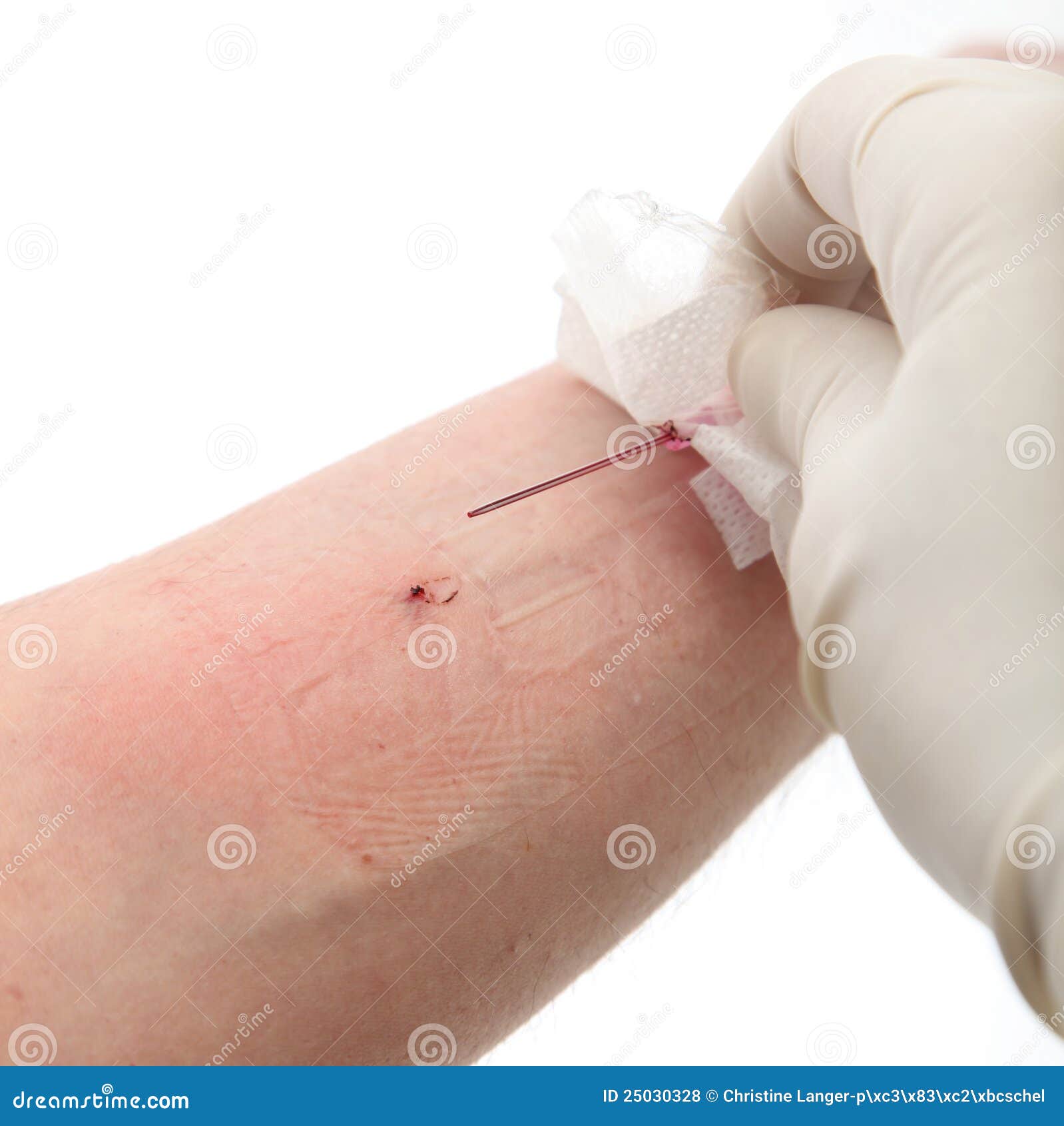 Intravenous Needle Being Withdrawn from Vein Stock Photo - Image of ...