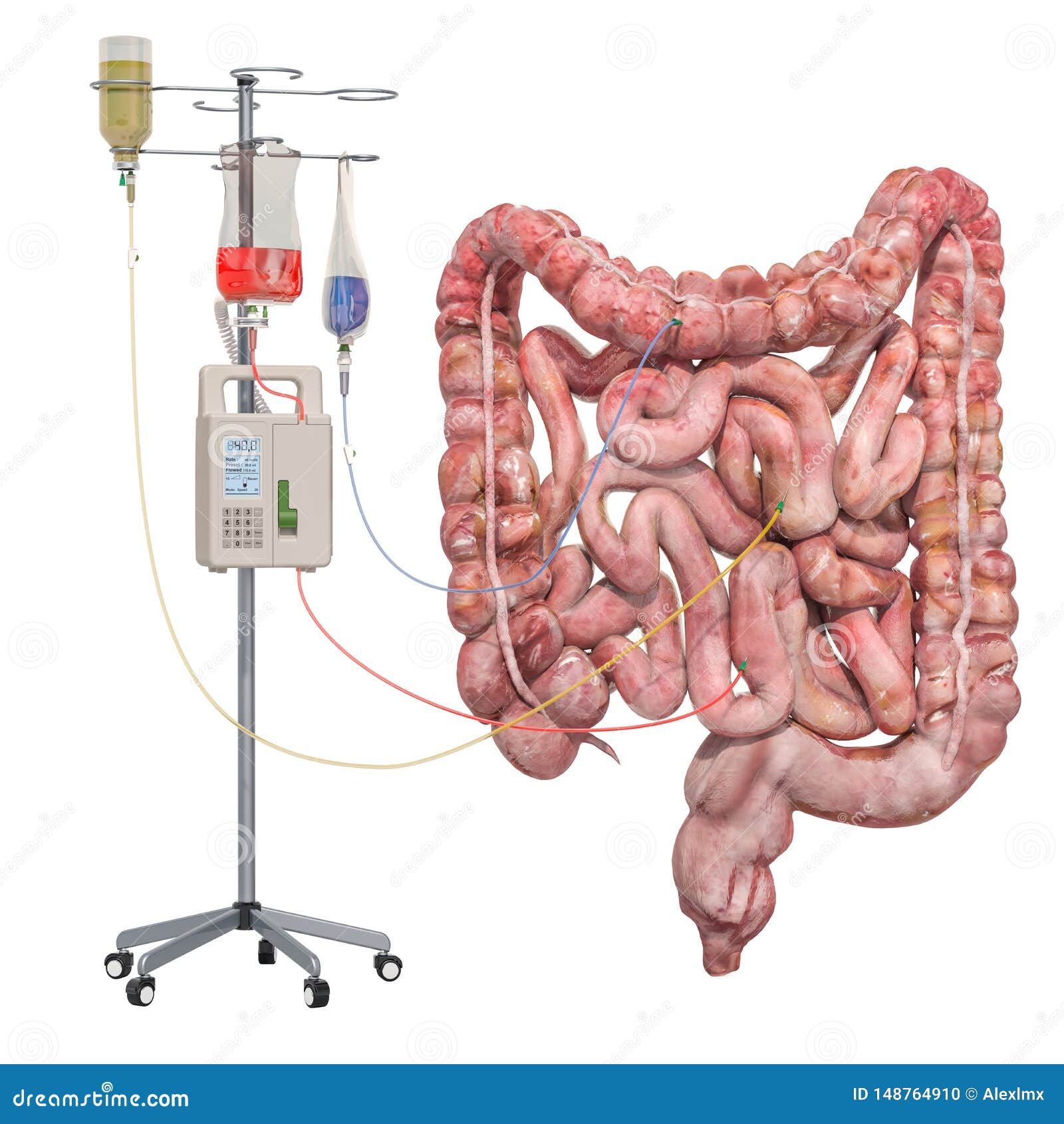 System For Intravenous Infusion With A Reducer. System For Intra ... System For Intravenous Infusion With A Reducer. System For Intra ...