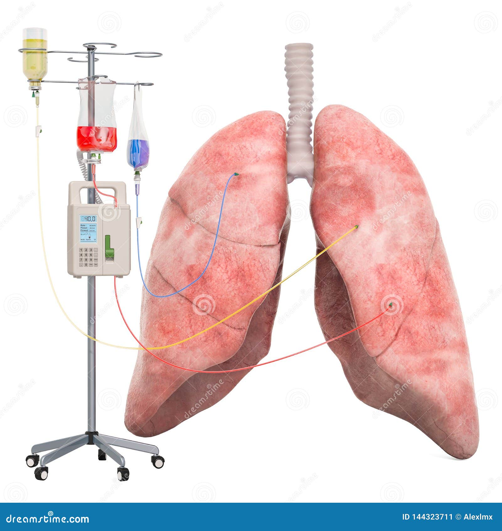 System For Intravenous Infusion With A Reducer. System For Intra ... System For Intravenous Infusion With A Reducer. System For Intra ...