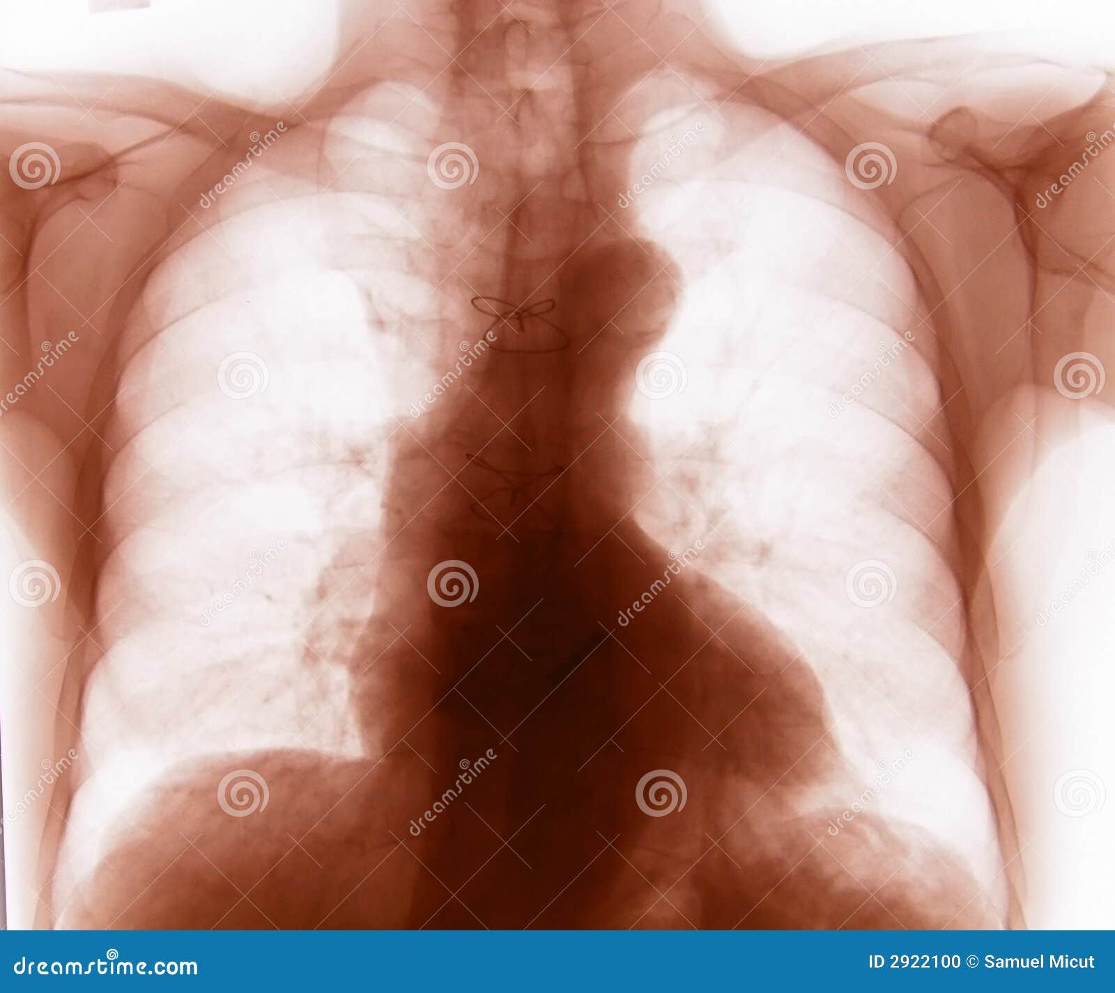 Inverted chest X-ray stock photo. Image of chest, blood - 2922100
