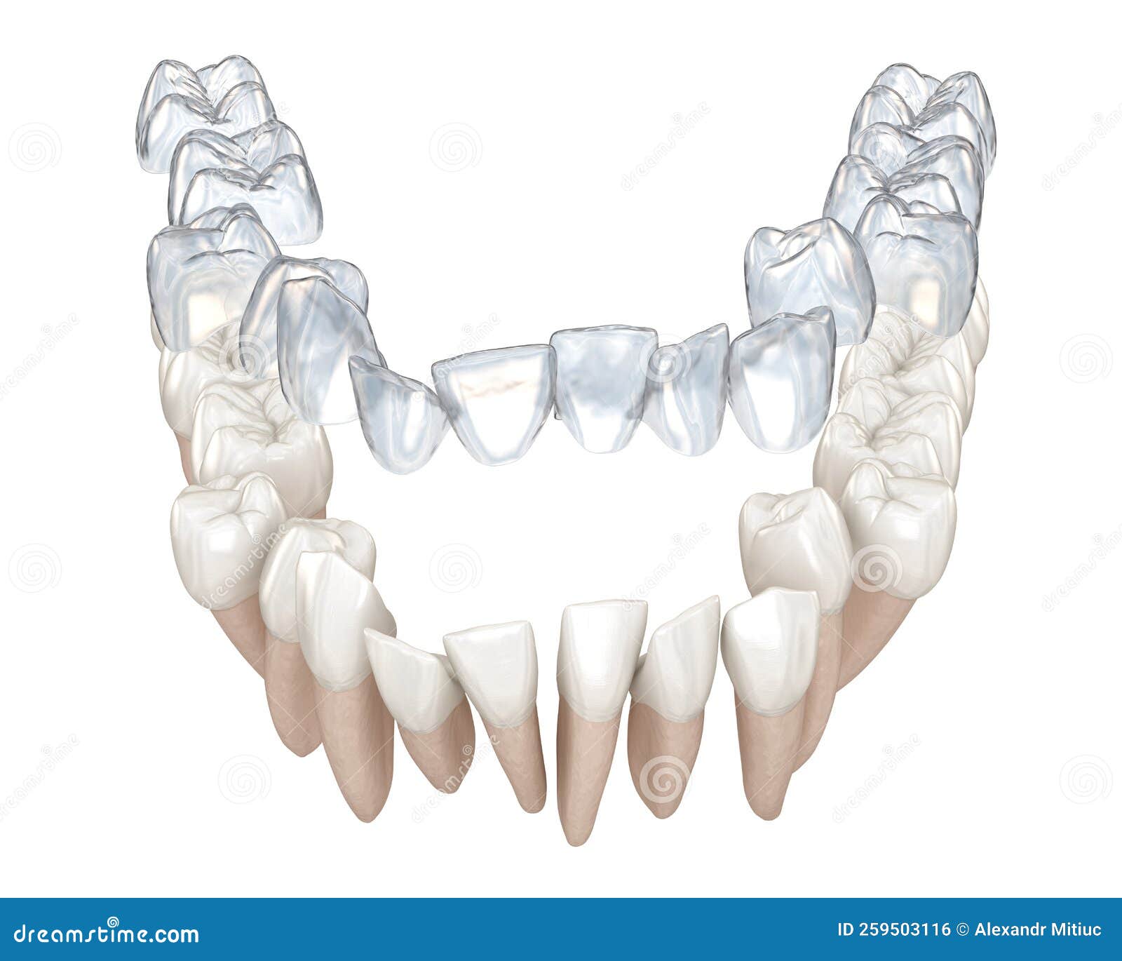 Invisalign Braces or Invisible Retainer Make Bite Correction. Medically ...